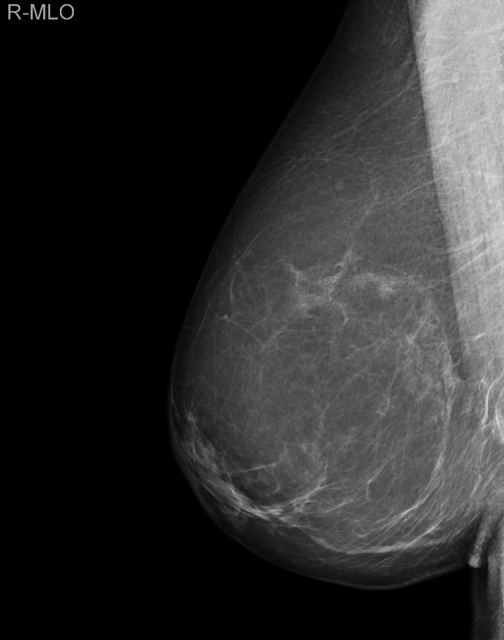 Wat is een mammografie? - Heilig Hartziekenhuis Mol